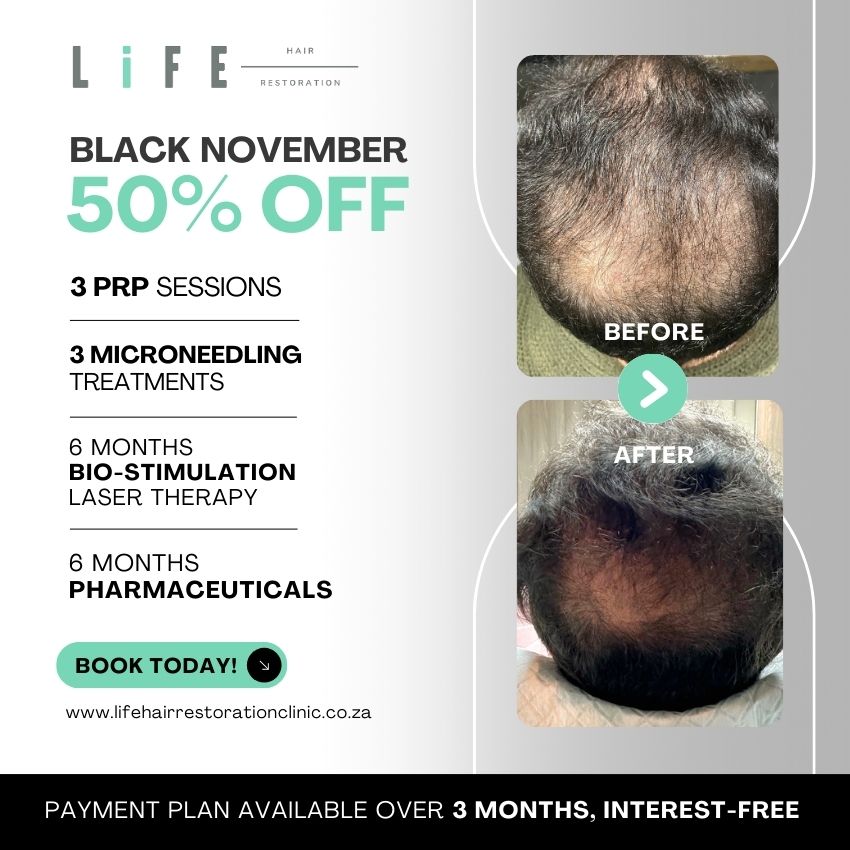 Black Friday 24 Promo Life Hair Restoration Clinic